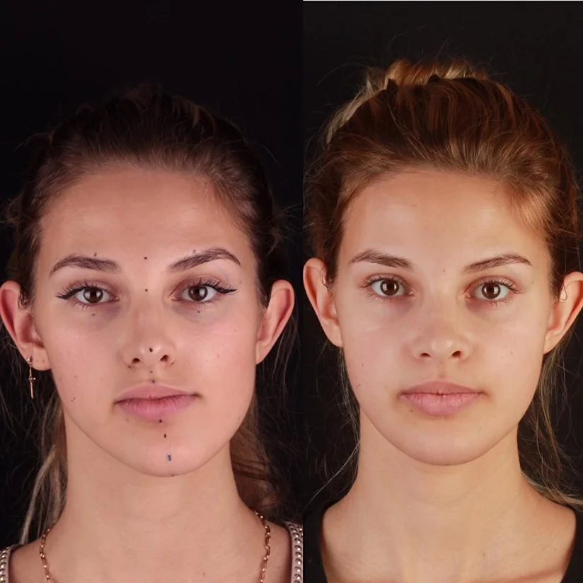 do face change after braces